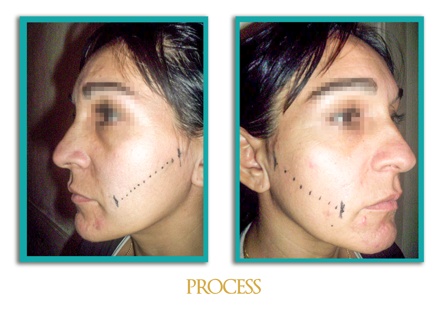 THREAD LIFTS (non-surgical face lift with the nova threads procedure) | Dr. Rubén Darío Cortés ...