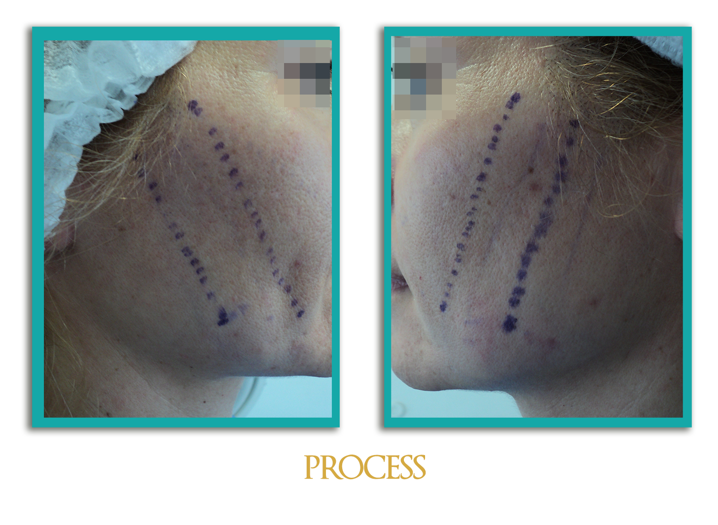 THREAD LIFTS (non-surgical face lift with the nova threads procedure) | Dr. Rubén Darío Cortés ...