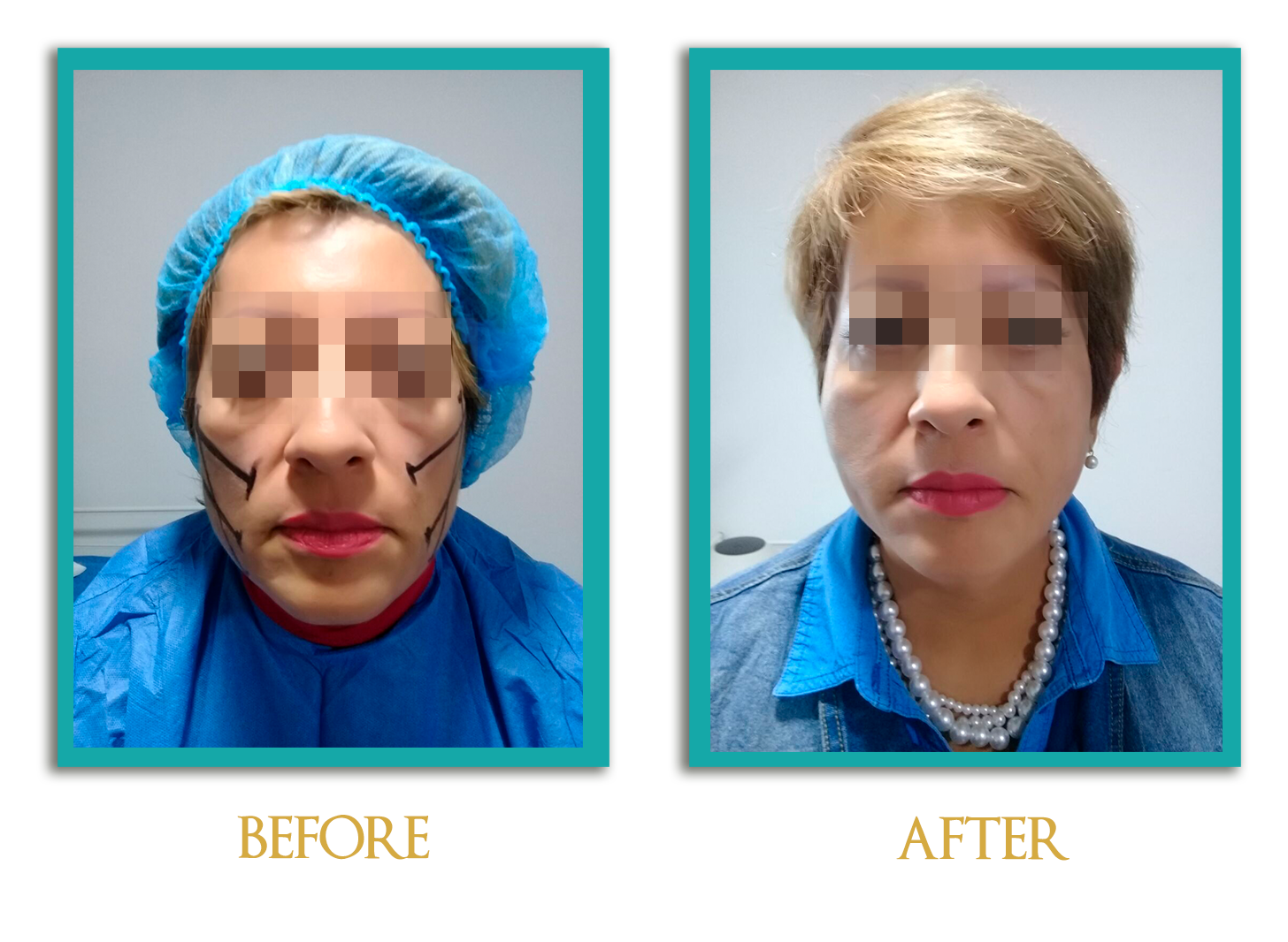 THREAD LIFTS (non-surgical face lift with the nova threads procedure) | Dr. Rubén Darío Cortés ...