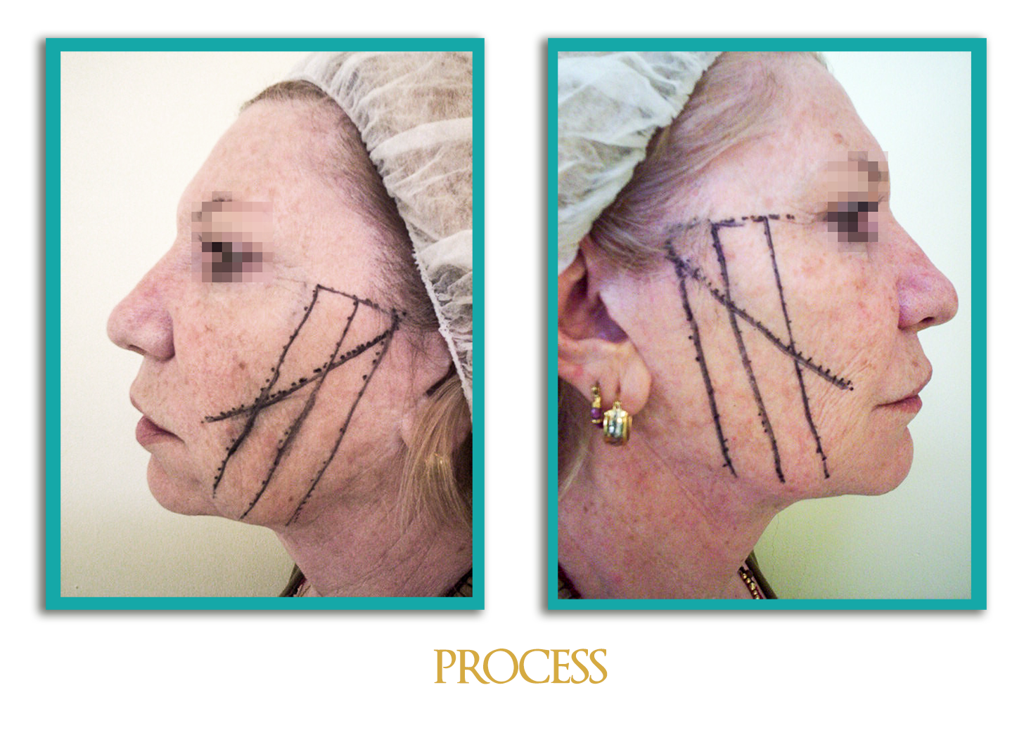 THREAD LIFTS (non-surgical face lift with the nova threads procedure) | Dr. Rubén Darío Cortés ...